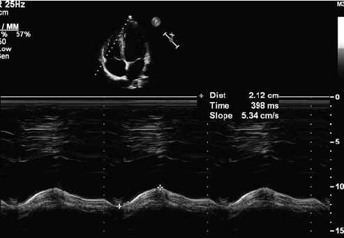 Do you POCUS? TAPSE TAPSE baby… - ABCmed